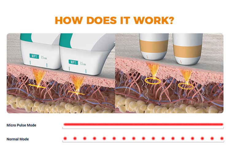 MPT HIFU 7D machine 2 in 1 FU3 - Buy hifu mpt, super hifu mpt, 7D HIFU ...